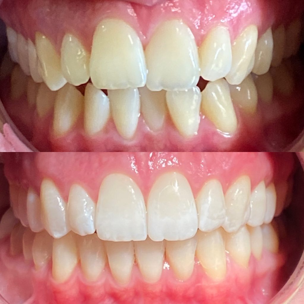Laura’s Lovely Smile – South Gables Dental